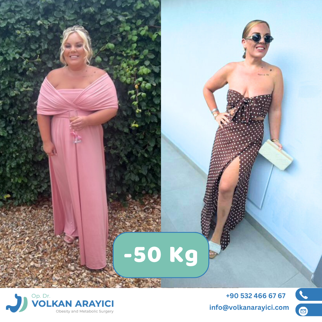 Your Stomach Pouch Stretched? Gastric ReSleeve In Turkey